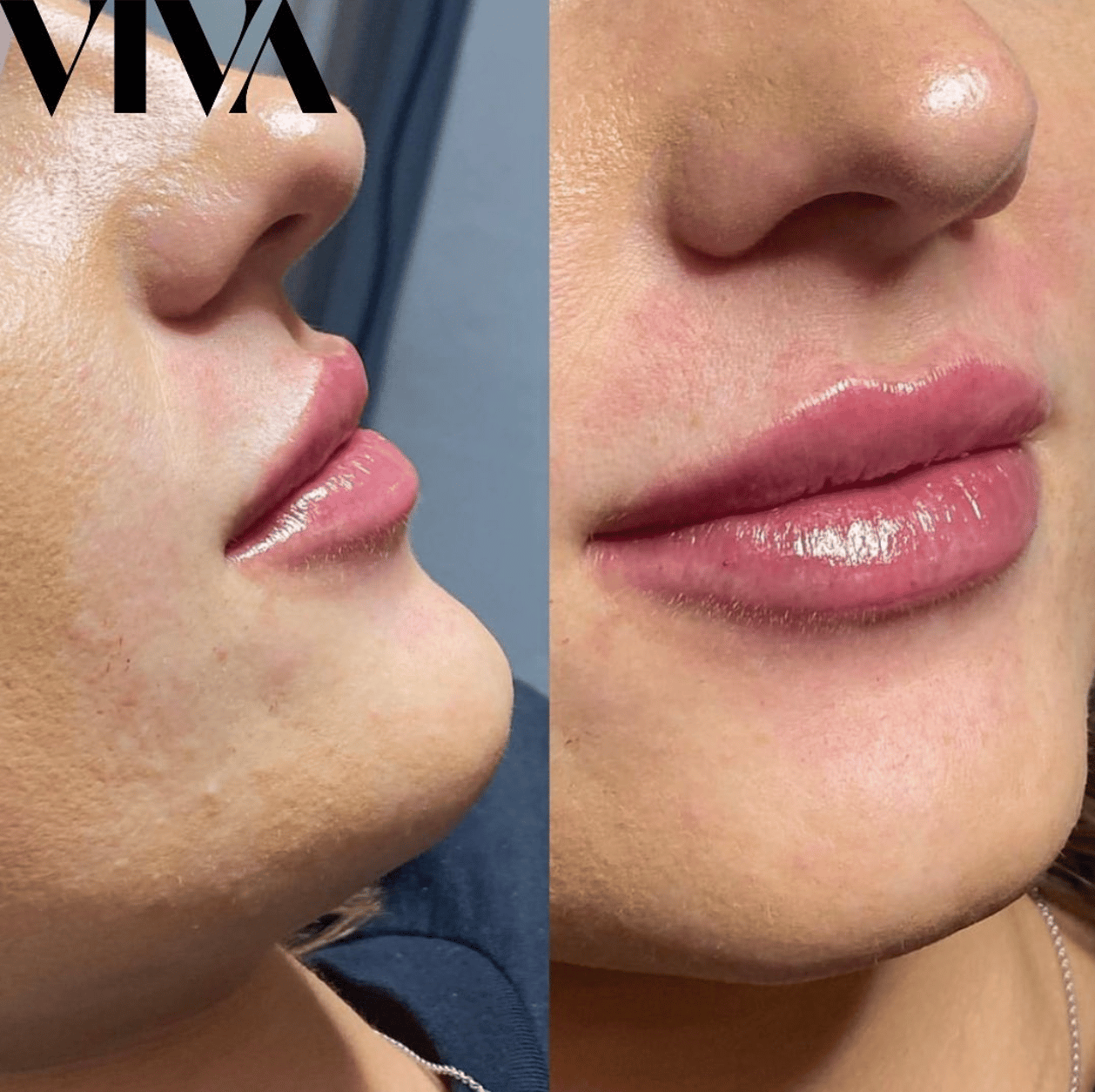 What Causes Duck Lips? - VIVA Skin Clinics