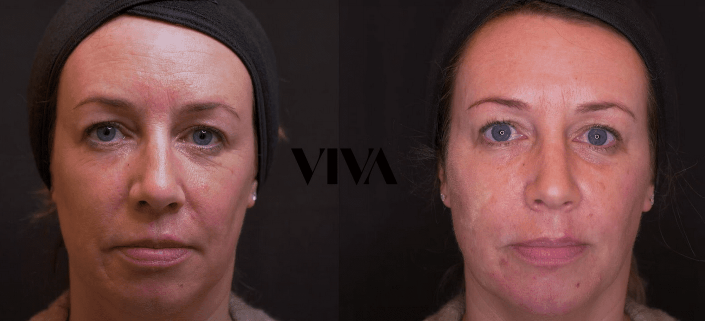 What Are Full Face Fillers? - VIVA Skin Clinics