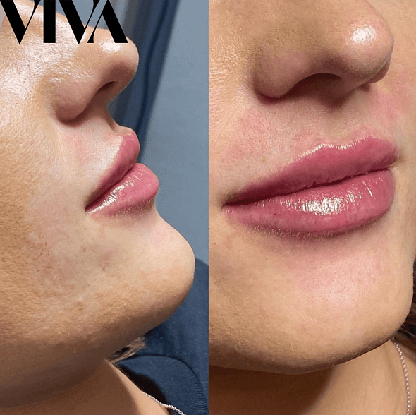 What Causes Duck Lips? - VIVA Skin Clinics